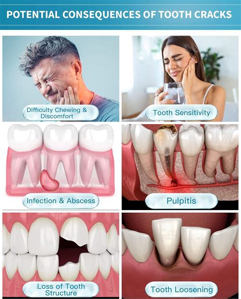 Caredo Healing Teeth Crack Toothpaste Repair Nepal Ubuy