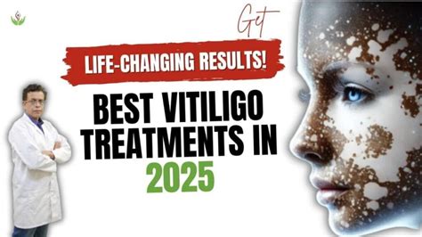 Best Vitiligo Treatments 2025 Effective Solutions And Advancements