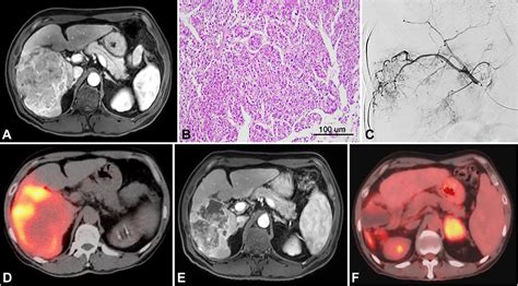 Outcomes In Patients With Macrotrabecular Massive Subtype Hepatocellular Carcinoma Treated With