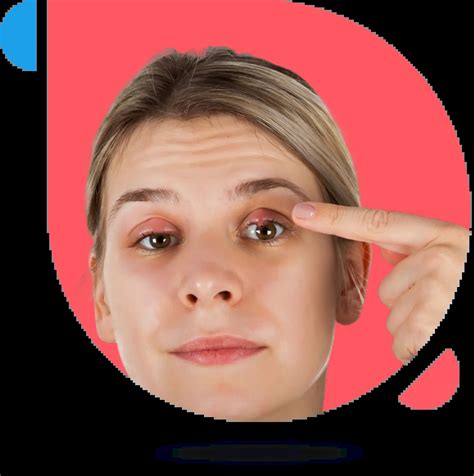 Stye Treatment And Prevention The Caremd