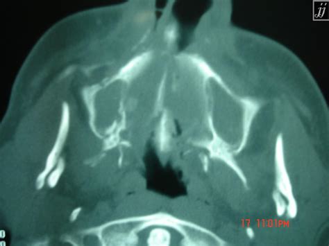 Ent Mandibular And Maxillary Fracture 8 Radioogle