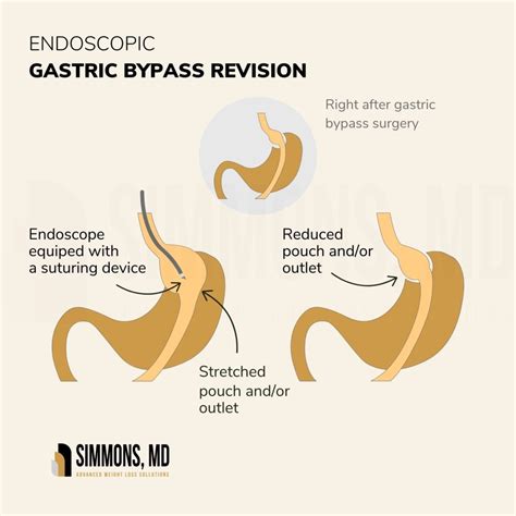 How Can Endoscopic Suturing Be Used For Bariatric Revision