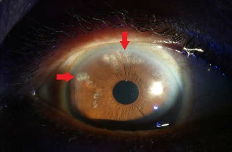 Six Months After Cataract Surgery In The Right Eye Note The Lpi Scars