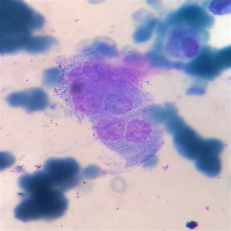 Bone Marrow Aspirate Smear Showing Very Scarce Groups Of Epitheloid
