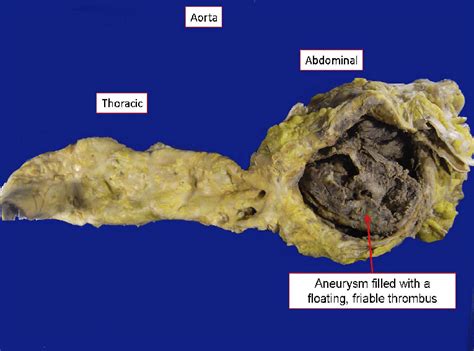 Opened Aorta Showing Diffuse Atherosclerosis And A Huge Abdominal Download Scientific Diagram