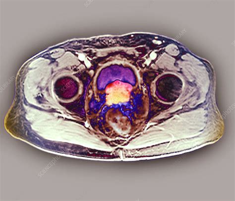 Prostate Cancer Mri Scan Stock Image M8650285 Science Photo Library