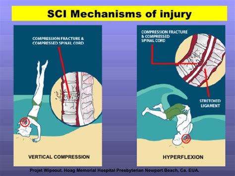 5 Unforgettable Facts About Diving And Spinal Cord Injuries Help Hope