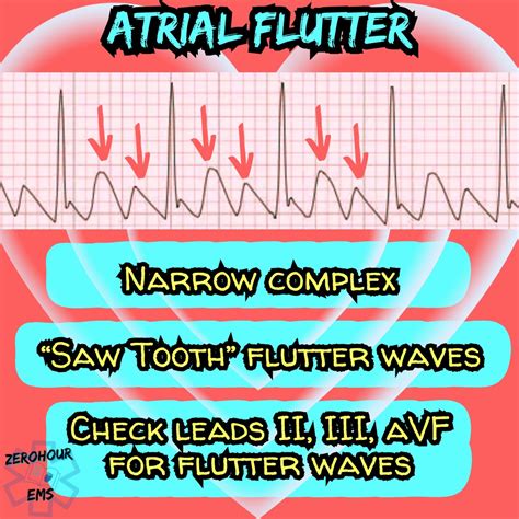 Zerohourems Atrial Flutter 💫 Caused By A Re Entry