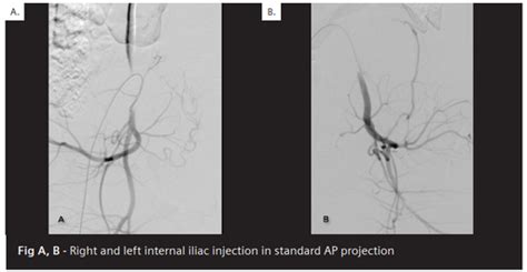 Three Dimensional Rotational Angiography In Uterine Fibroid Embolization