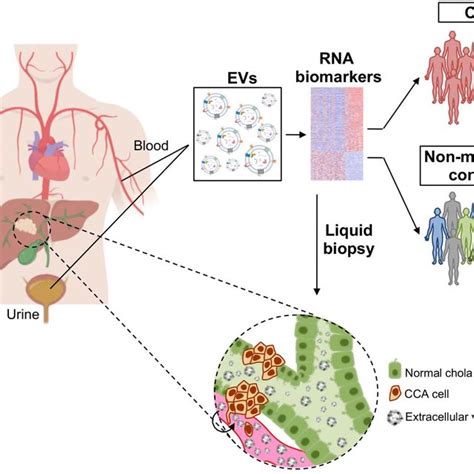 Novel Liquid Biopsy Approach For Cholangiocarcinoma Cca Tumor Cells