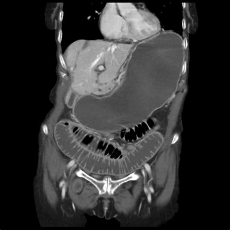 Obstructed Obturator Hernia Radiopaedia 75197 86293 B Nc Commons