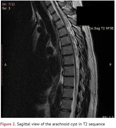 Thoracic Intradural Extramedullar Arachnoid Cyst In An Adult Case