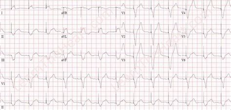 Ventricular Paced Rhythm