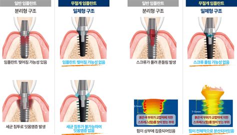 무절개 임플란트 연세위드치과