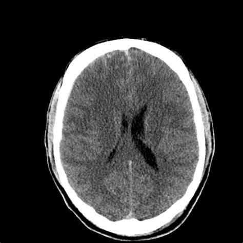 Radiopaedia Case Cerebral Hemorrhagic Contusions Temporal Evolution Id