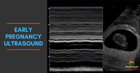 Early Pregnancy Ultrasound Normal Appearances And Complications