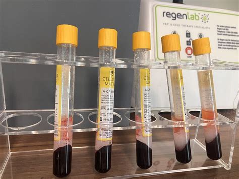 msk injections re introduces prp the physios ltd posted on the topic