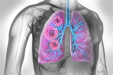 Osimertinib Plus Chemotherapy Prolongs Pfs In Egfr Mutated Nsclc