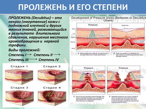 Уход за кожей и естественными складками Профилактика и лечение