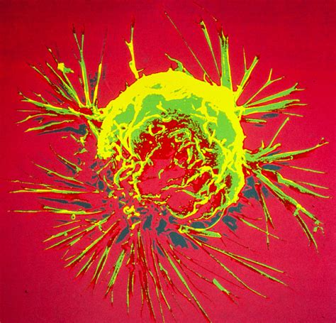 Targeted Drug Palbociclib Stops Tumour Growth In Patients With