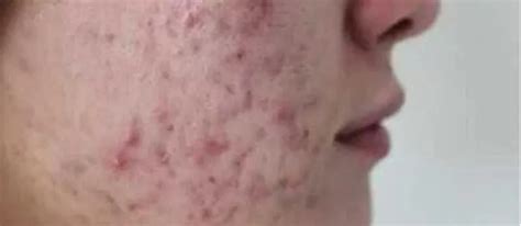 Красные пятна на лице причины Coolaser Clinic
