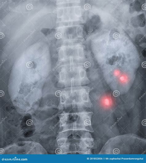 Intravenous Pyelogram Or I V Stock Photo Image Of Calyces Intravenous