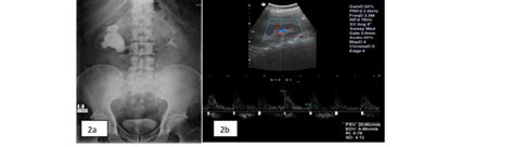 A B 15 Min Ivp Film Showing No Contrast Filling In The Right Ureter