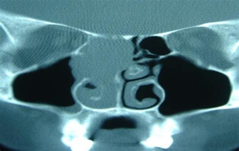 Ct Scan Of A Patient With An Inverted Papilloma Of The Right Nasal Download Scientific Diagram