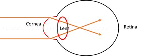 Axial Length In Myopia Management Why Does It Matter