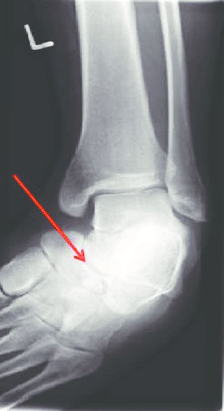 Anterioposterior Radiograph Of Left Foot Demonstrating Medial Download Scientific Diagram