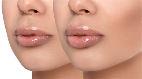 No More Lip Filler With Lip Implants Youtube