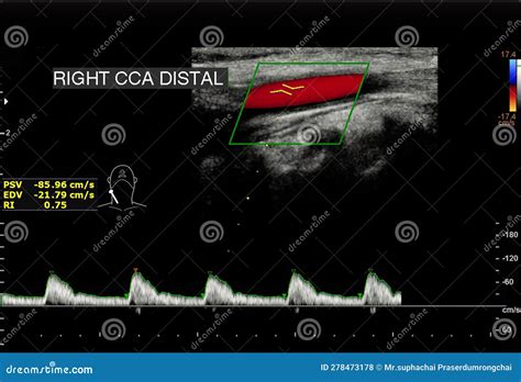 A Carotid Artery Doppler Ultrasound Is A Diagnostic Test Used To Check