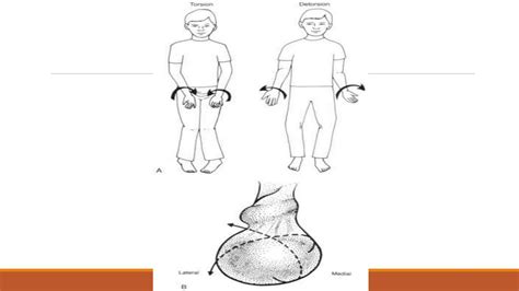 Testicular Torsion Surgical Emergency Pptx