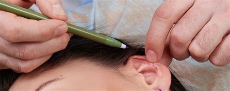 Otoplasty Operasi Untuk Memperbaiki Kondisi Daun Telinga Hello Sehat