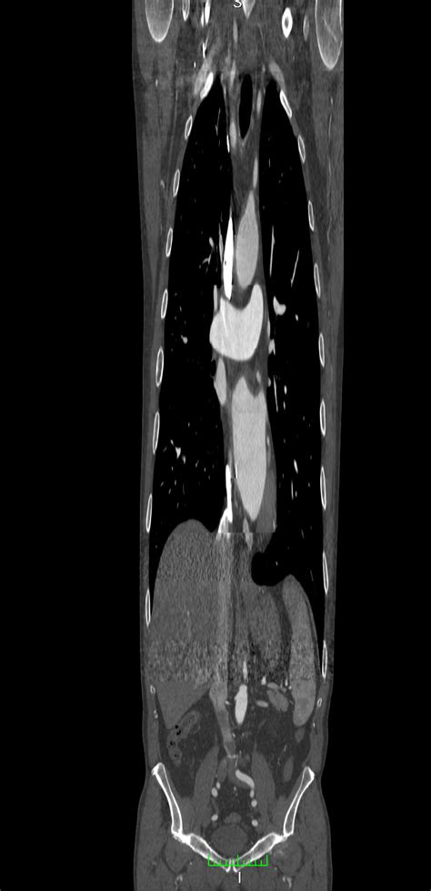 Dicom Geometry With Non Regular Slice Intervals Researchgate