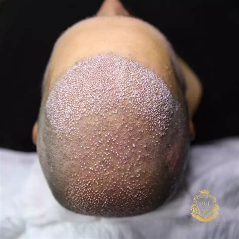 What Are The Side Effects And Risks Of Hair Transplantation