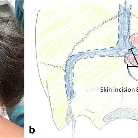 How I Do It Endoscopic Supracerebellar Infratentorial Approach For Torcular Meningioma Removal