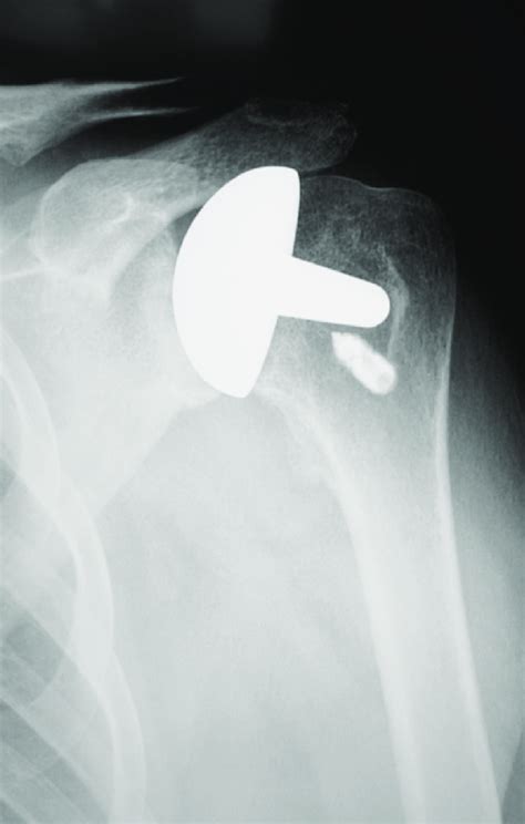 Postoperative Radiograph After Copeland Shoulder Resurfacing Operation
