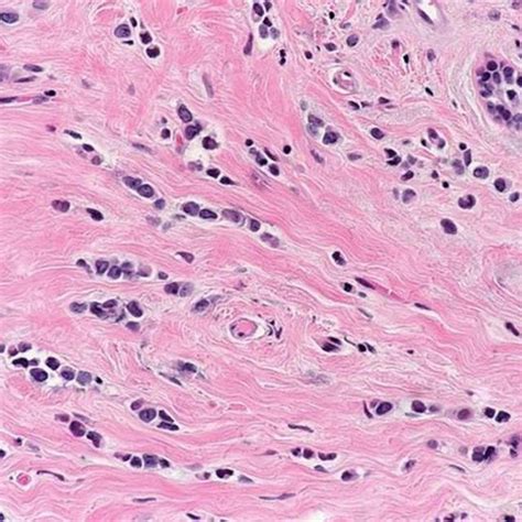 Breast Ultrasound Demonstrating An Irregular Hypoechoic Ill Defined