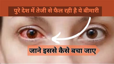 Eye Flu Conjunctivitis पुरे देश में तेजी से फैल रही है ये बीमारी जाने