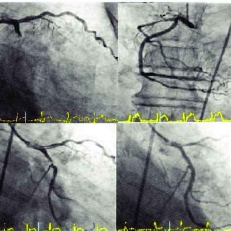 Proximal Portion Of The Cx Was Occluded Lad And Rca Were Plaque Ptca