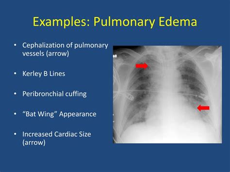 Cephalization Of Pulmonary Vessels