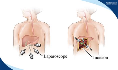 Laparoscopic Vs Open Surgery Choosing The Right Surgical Approach
