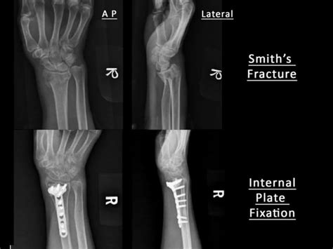 Distal End Radius Fractures Colles Smiths And Bartons Pptx