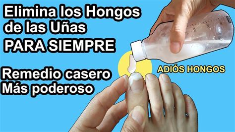 Esta Mezcla Elimina los Hongos de las Uñas de los pies y de las Manos