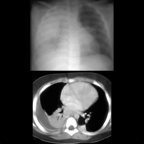 Pediatric Pleural Empyema Pediatric Radiology Reference Article