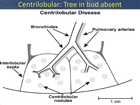 Ppt Lung Nodules Powerpoint Presentation Free Download Id 2372940