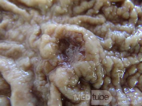 Adenocarcinoma Of The Antrum And Incisura Angularis 7 Of 12 • Image