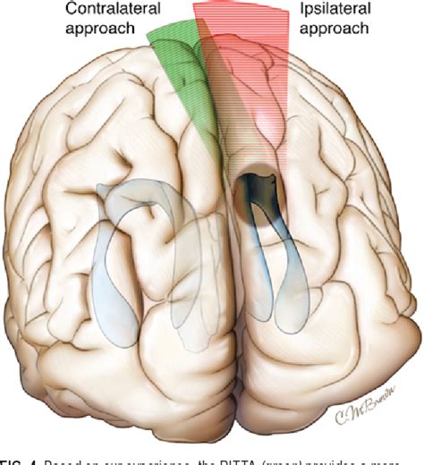 Figure 4 From Posterior Interhemispheric Transfalcine Transprecuneus Approach For Microsurgical