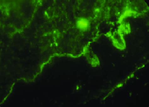 Deposition Of Igg In A Broad Continuous Linear And Granular Pattern Download Scientific